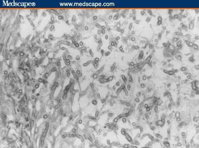 Local Arterial Infusion of Amphotericin B - Page 2