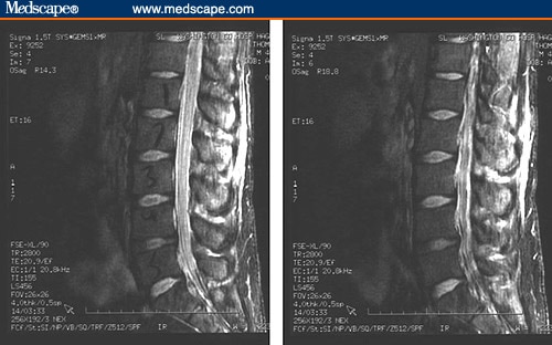 Johns Hopkins Case #15: Rapidly Progressing Leg Weakness