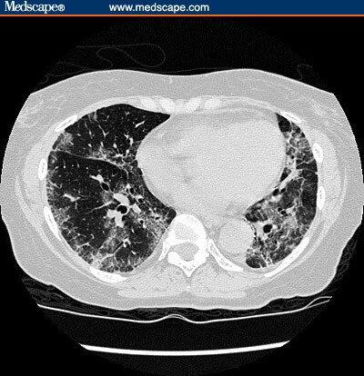 Renal Tx Recipient With Cough and Shortness of Breath - Page 6
