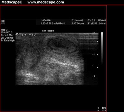 Newborn Male With Dusky and Swollen Left Hemiscrotum