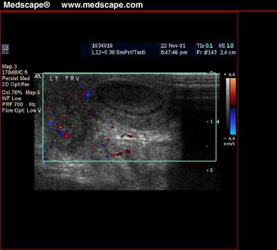Newborn Male With Dusky and Swollen Left Hemiscrotum