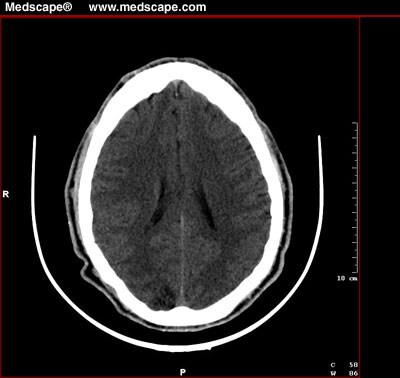Right Lower Extremity Weakness