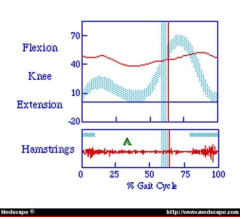 Clinical Gait Analysis and Its Role in Treatment Decision-Making - Page 4