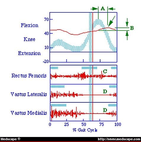 Clinical Gait Analysis and Its Role in Treatment Decision-Making - Page 4