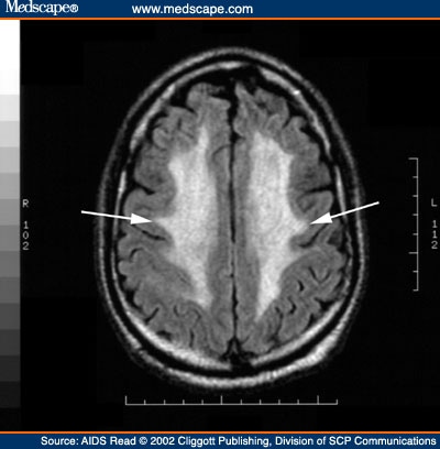 HIV-1-Associated Dementia