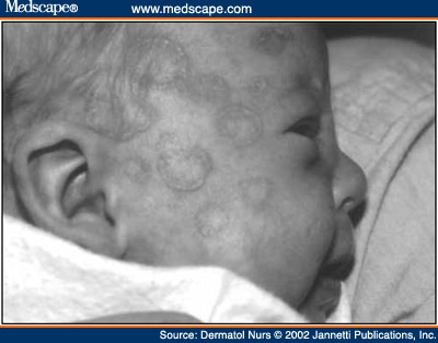Neonatal Lupus Erythematosus - Page 4