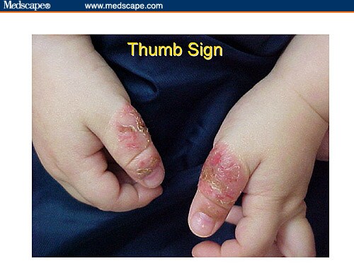 Report From the SPD Annual Meeting, Part 1