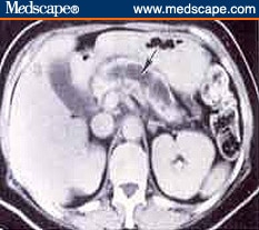 Chronic Pancreatitis - Page 7