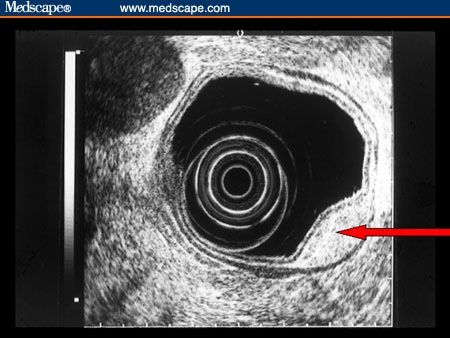 Endoscopic Ultrasonography: The State of the Art - Page 2