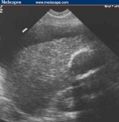 Vague Abdominal Pain