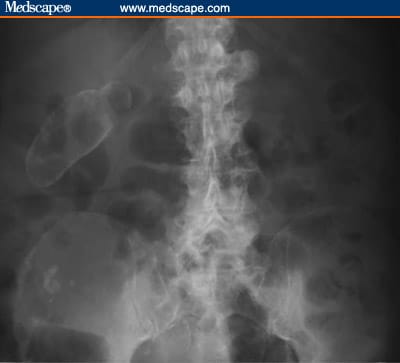 Vague Abdominal Pain