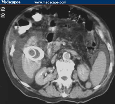 Vague Abdominal Pain