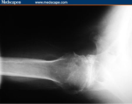 Osteoarthritis of the Glenohumeral Joint - Page 2