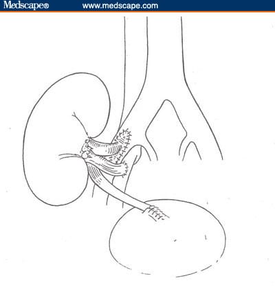 Kidney Transplantation - Page 8