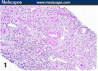 Histologic Findings of Acute Interstitial Nephritis?