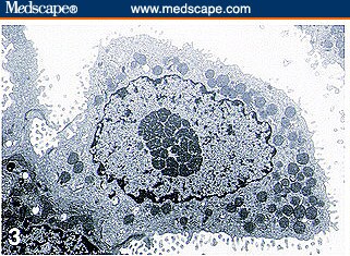 Histologic Findings of Acute Interstitial Nephritis?