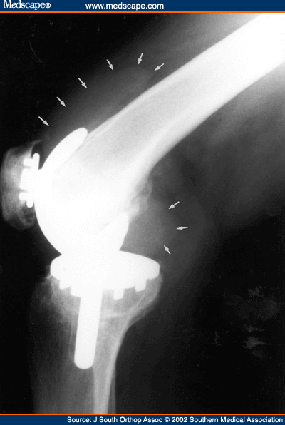 Radiographic Evaluation of Periprosthetic Metallosis - Page 2