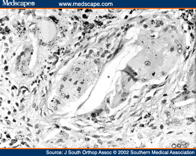 Radiographic Evaluation of Periprosthetic Metallosis - Page 2