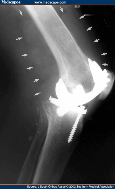 Radiographic Evaluation of Periprosthetic Metallosis - Page 4
