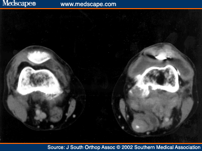 Radiographic Evaluation of Periprosthetic Metallosis - Page 4