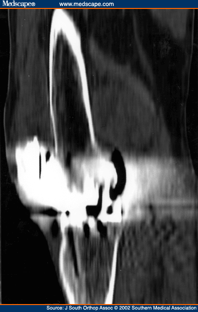 Radiographic Evaluation of Periprosthetic Metallosis - Page 4