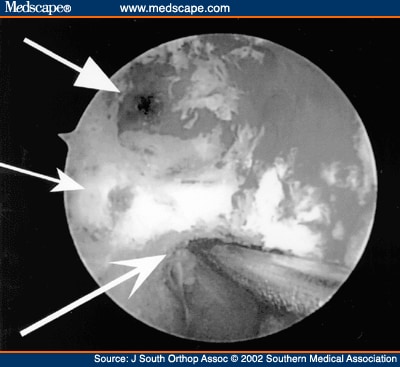 Revision Anterior Cruciate Ligament Reconstruction Surgery - Page 2