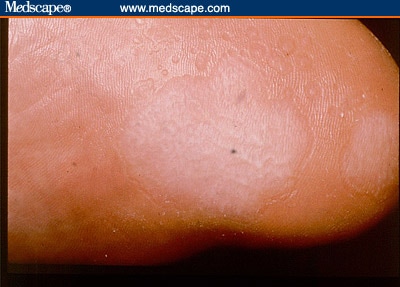 Macerated, Smelly Feet