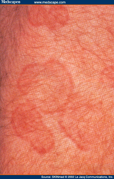 Cutaneous Reactions to Antibacterial Agents - Page 3