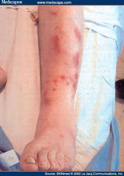 Nocardia Otitidiscaviarum