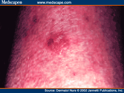 Actinic Keratoses and Skin Cancer