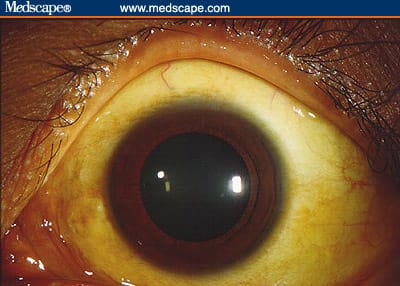 Cirrhosis in a Young Woman From Central America - Page 2