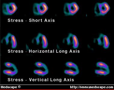 Gender Bias in Evaluating Coronary Disease in Women - Page 4