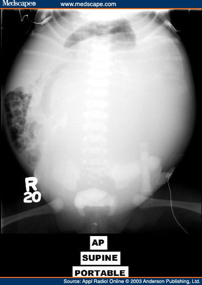 Newborn With Palpable Mass