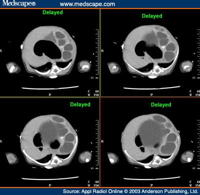 Newborn With Palpable Mass