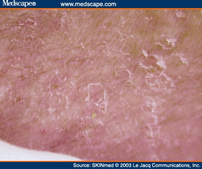 Diagnosis of Hospitalized Dermatology Consultation Patients - Page 4