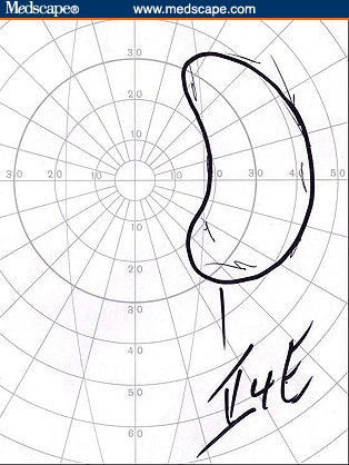 Bilateral Visual Loss With Normal Pupillary Light Reaction