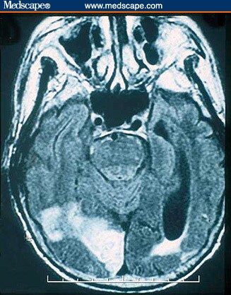 Bilateral Visual Loss With Normal Pupillary Light Reaction - Page 2