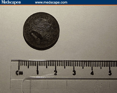 Coin Ingestion, an Unexpected Finding at Colonoscopy