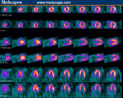 Role of Myocardial Perfusion Imaging in Managing CAD - Page 6