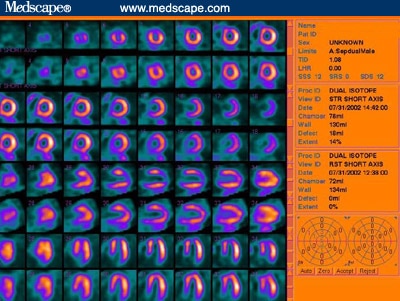 What Is The Cpt Code For Lexiscan Cardiolite Stress Test