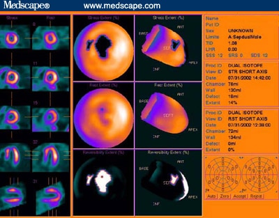 Role of Myocardial Perfusion Imaging in Managing CAD - Page 7