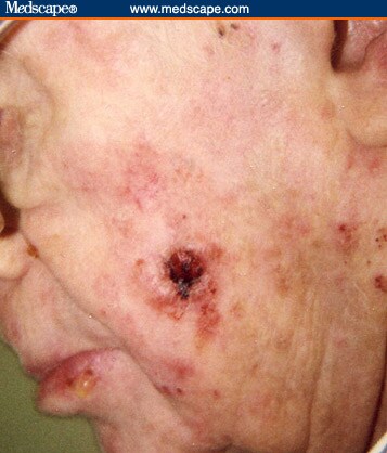 A Recurrent, Rapidly Growing Tumor of the Left Cheek
