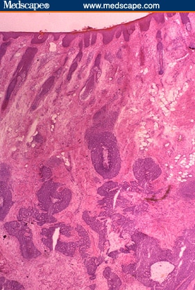 A Recurrent, Rapidly Growing Tumor of the Left Cheek