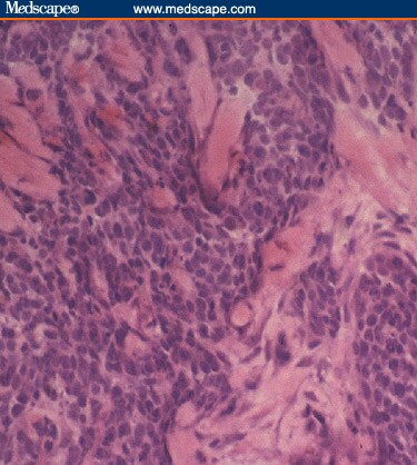 A Recurrent, Rapidly Growing Tumor of the Left Cheek