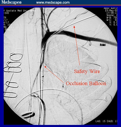 Interventional Perspectives, Case V: Overwhelming Sepsis