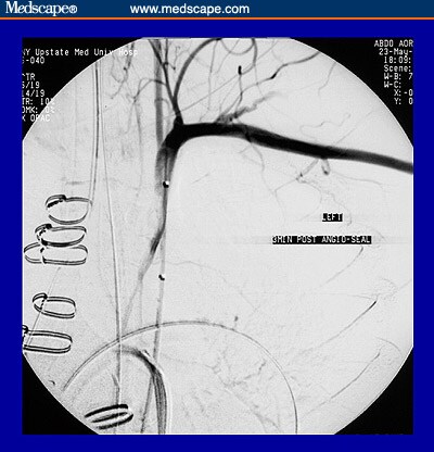Interventional Perspectives, Case V: Overwhelming Sepsis