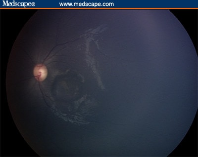 Macular Retinal Tumor in a Child