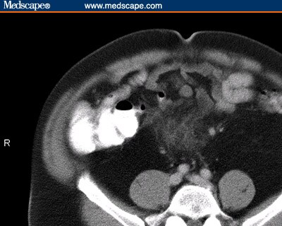 Perforation of the Colon Presenting as Abdominal Pain and Sepsis - Page 2