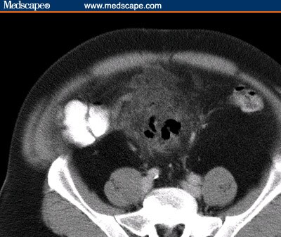 Perforation of the Colon Presenting as Abdominal Pain and Sepsis - Page 2