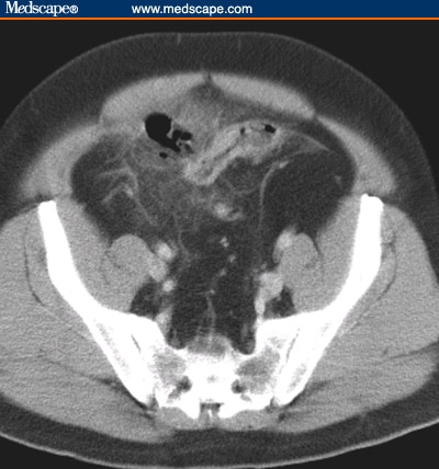 Perforation of the Colon Presenting as Abdominal Pain and Sepsis - Page 2